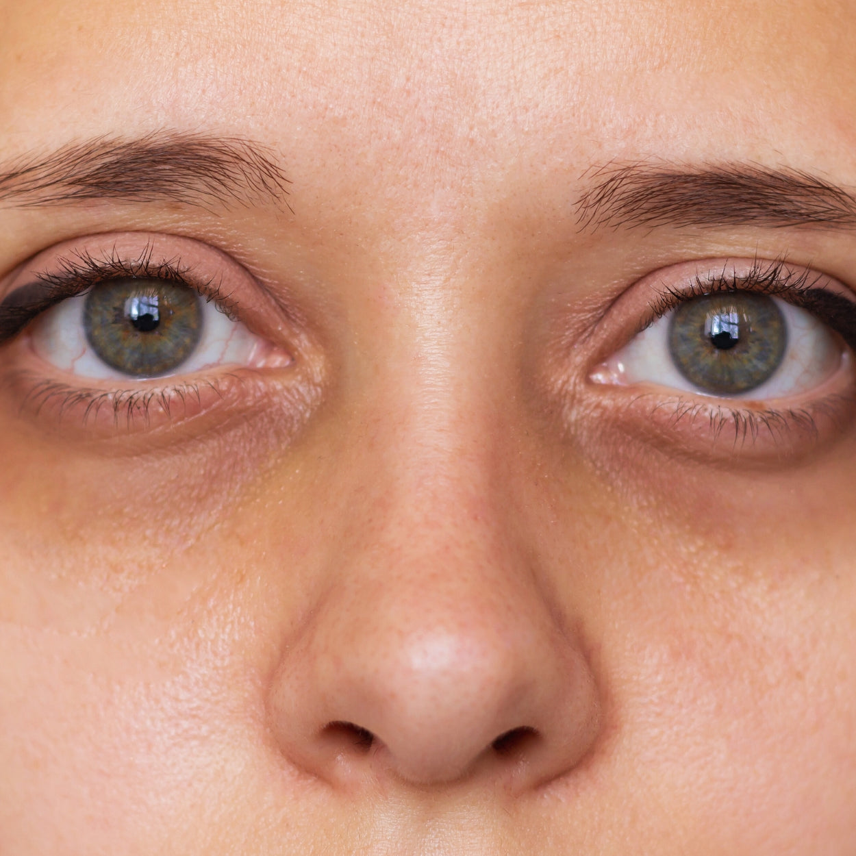 Dark Circles – Skin Science