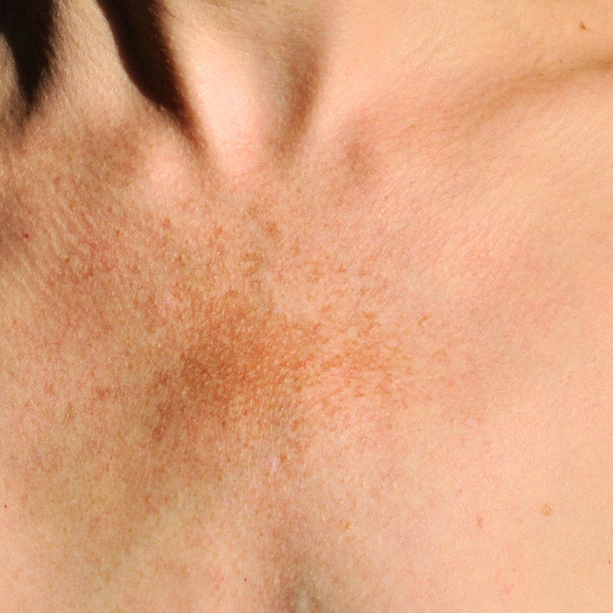 Melasma – Skin Science