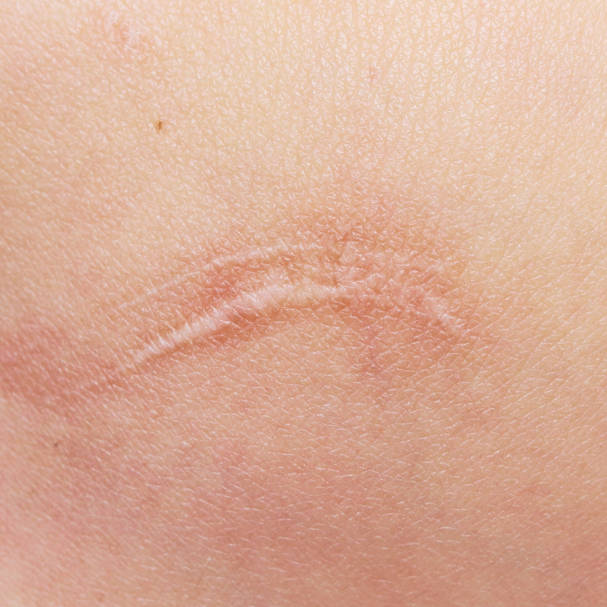 Scars – Skin Science